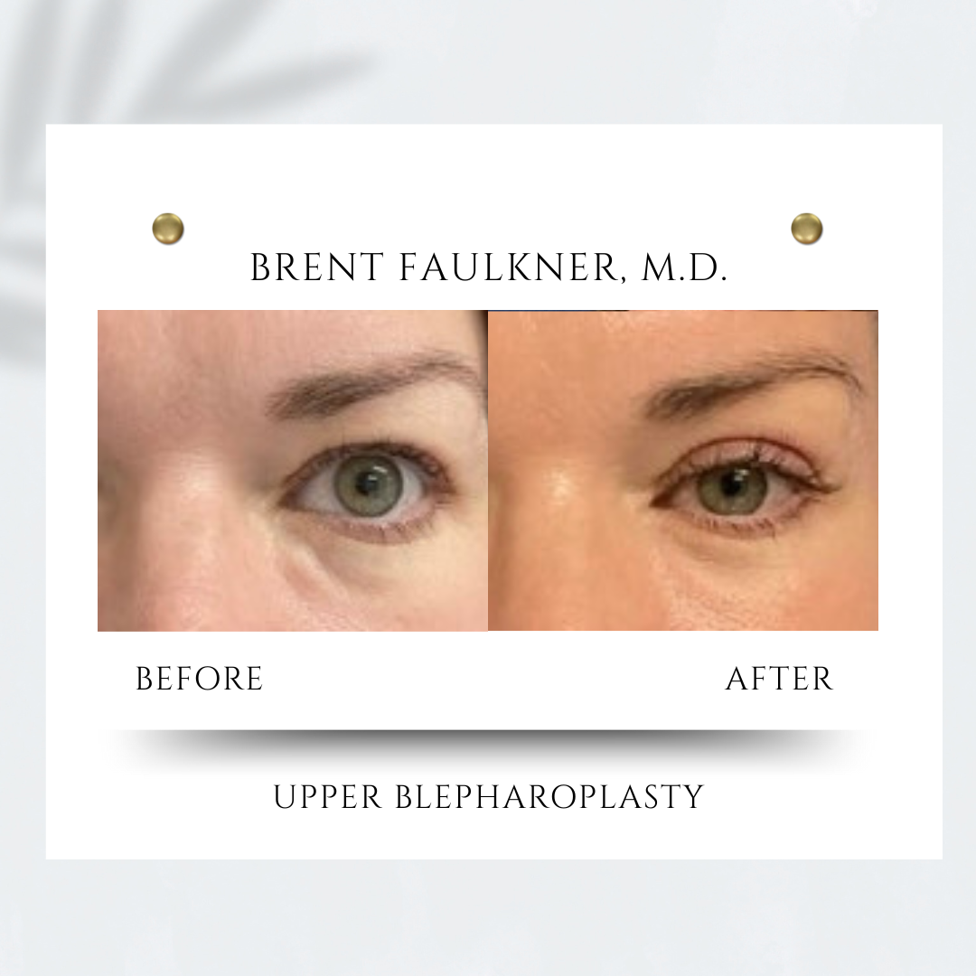 Upper Bleph Near Rockville | Faulkner Plastic Surgery & Aesthetics